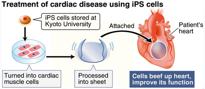 Vers une première étude clinique sur l’application de cellules iPS dans ...